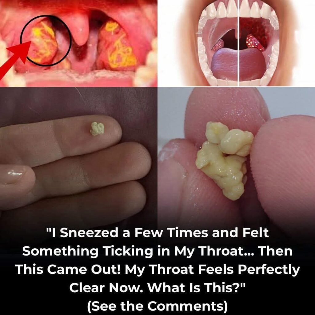 Everything You Need to Know About Tonsil Stones – Grandma's Recipes